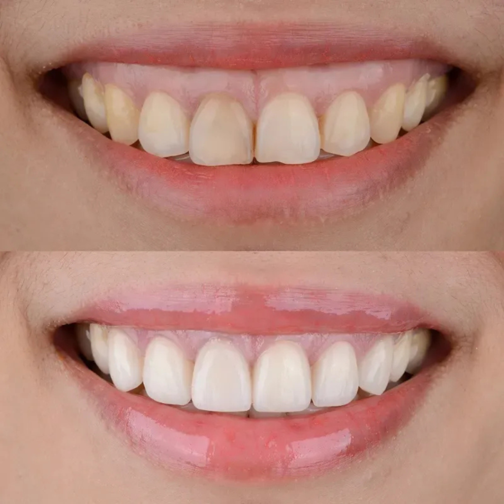 Laser-Aided Dentistry | Mandent Dental Clinic